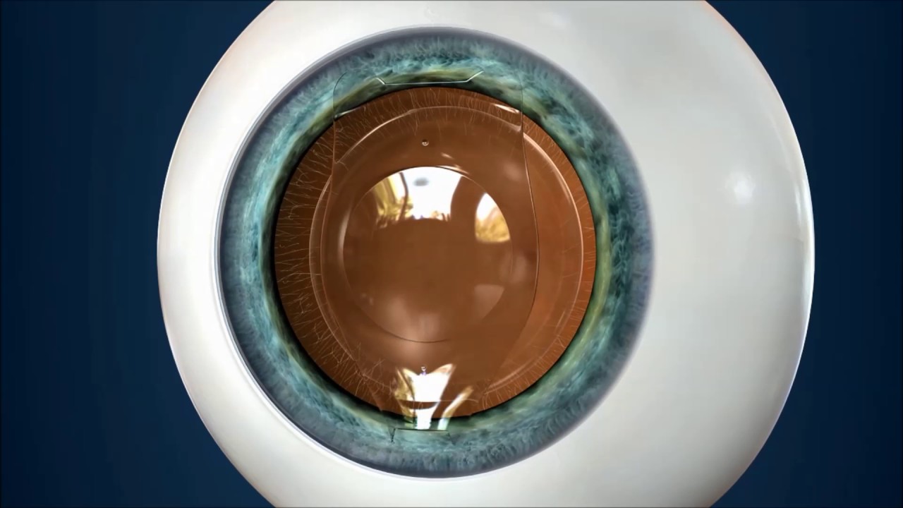 EVO Visian ICL - YouTube