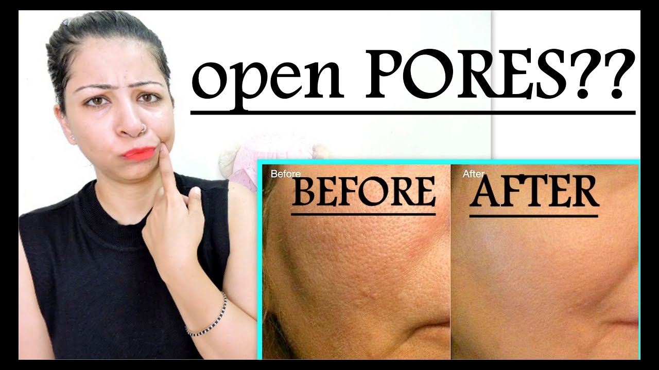 Home Remedies for Open Pores | How to Get Rid of Large/Open Pores| 100% ...