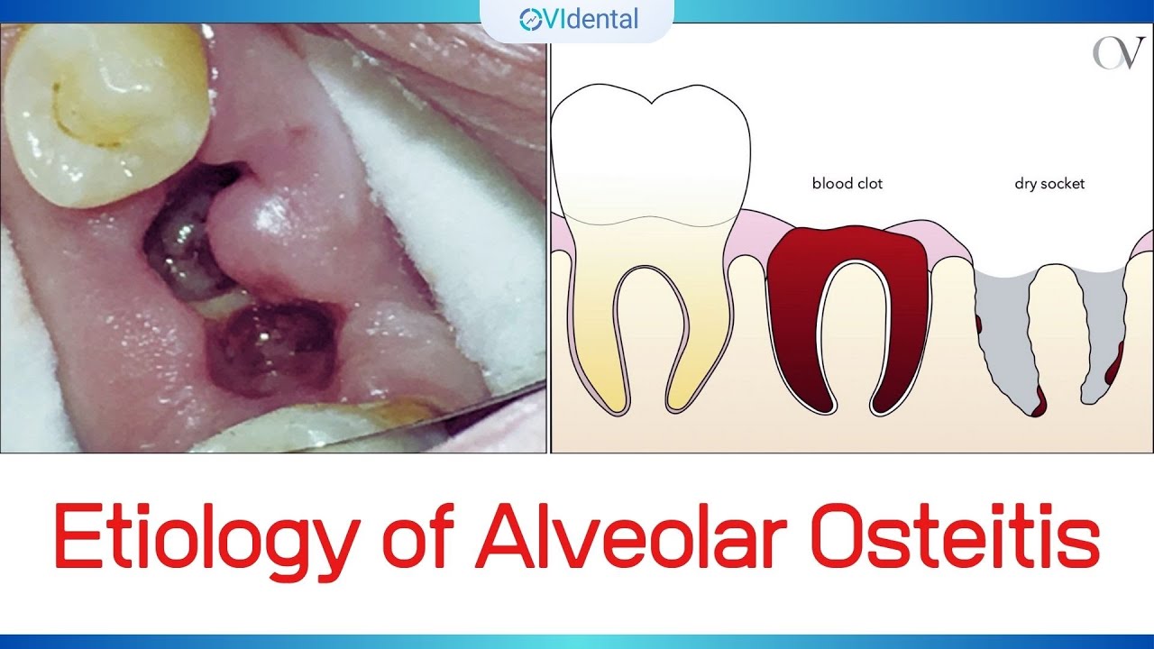 🚫 Etiology of Alveolar Osteitis (AO) - YouTube