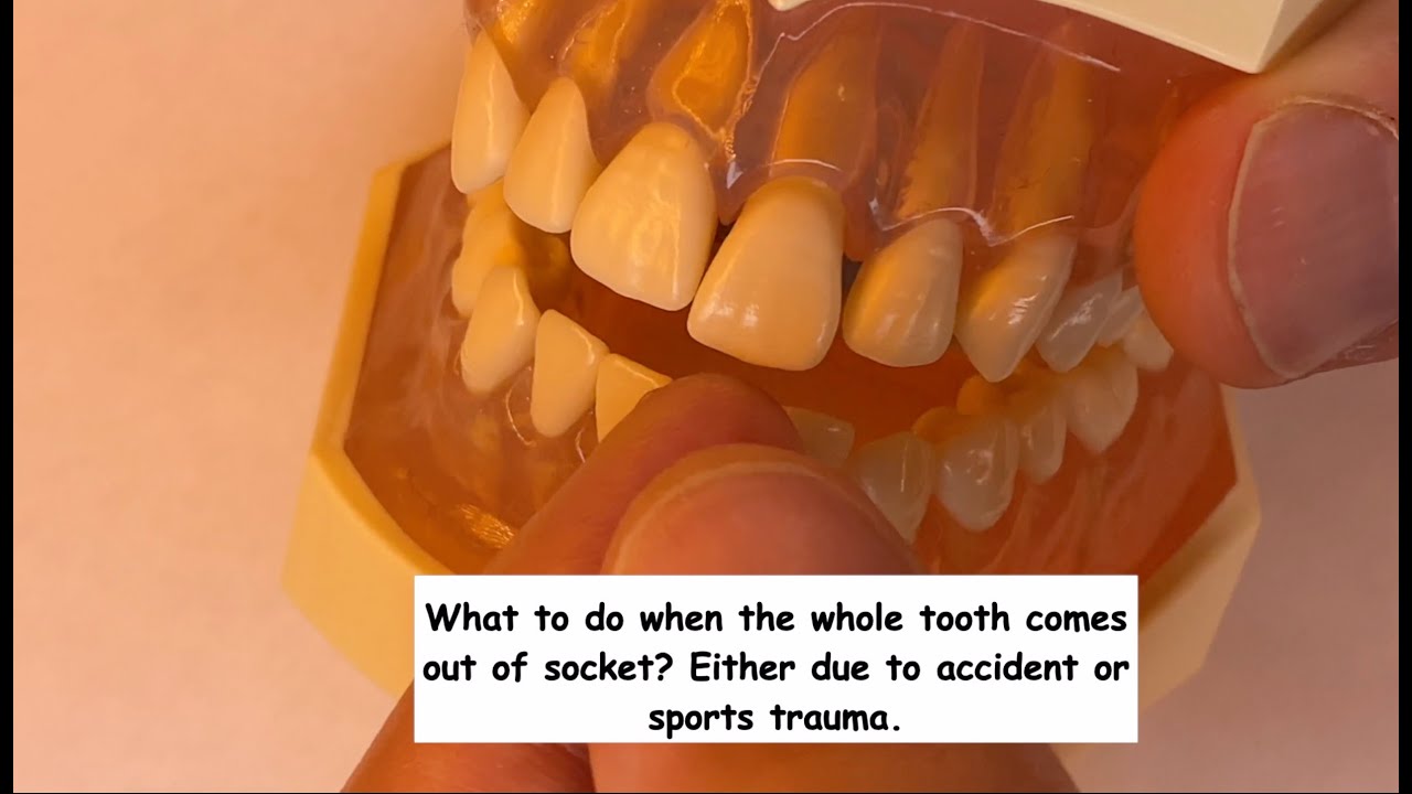 What to do when the whole tooth comes out of its socket? Avulsion ...