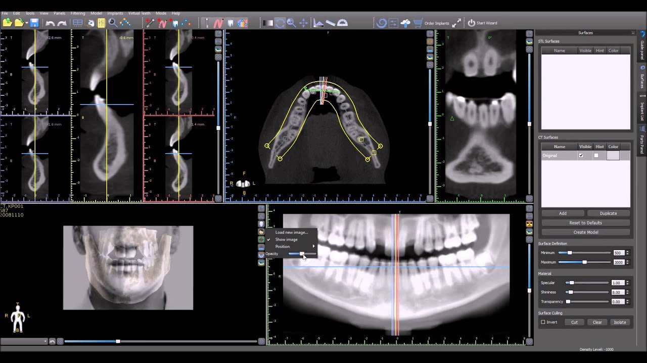 Blue Sky Plan Training Tutorial: Loading Patient Photo in 3D View - YouTube