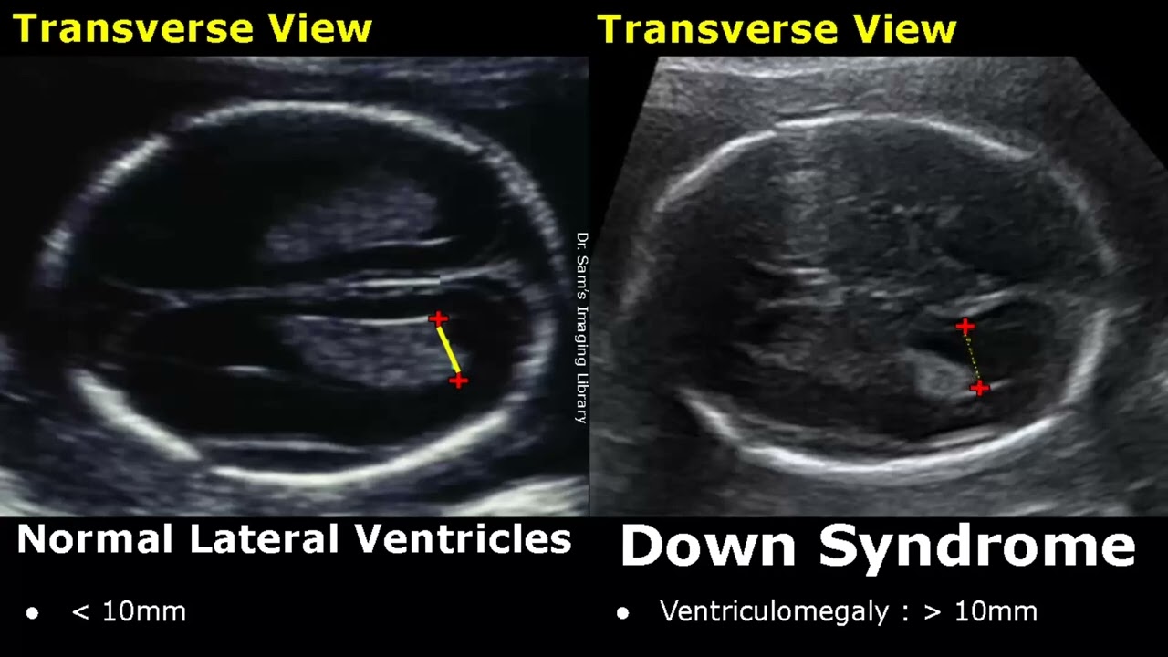 Fetal Ultrasound Normal Vs Down Syndrome Soft Markers In Fetus For Fetal Ultrasound Normal Vs Down Syndrome Soft Markers In Fetus For
