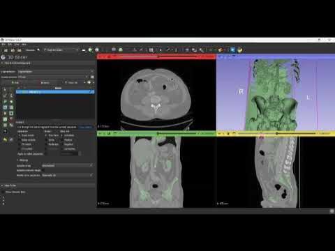 Threshold segmentation using slicer 3D - YouTube