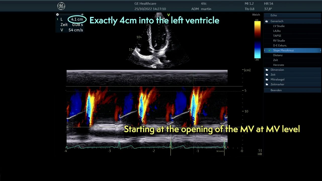 Echocardiography Color M Mode Flow Propagation Measurement Echocardiography Color M Mode Flow Propagation Measurement