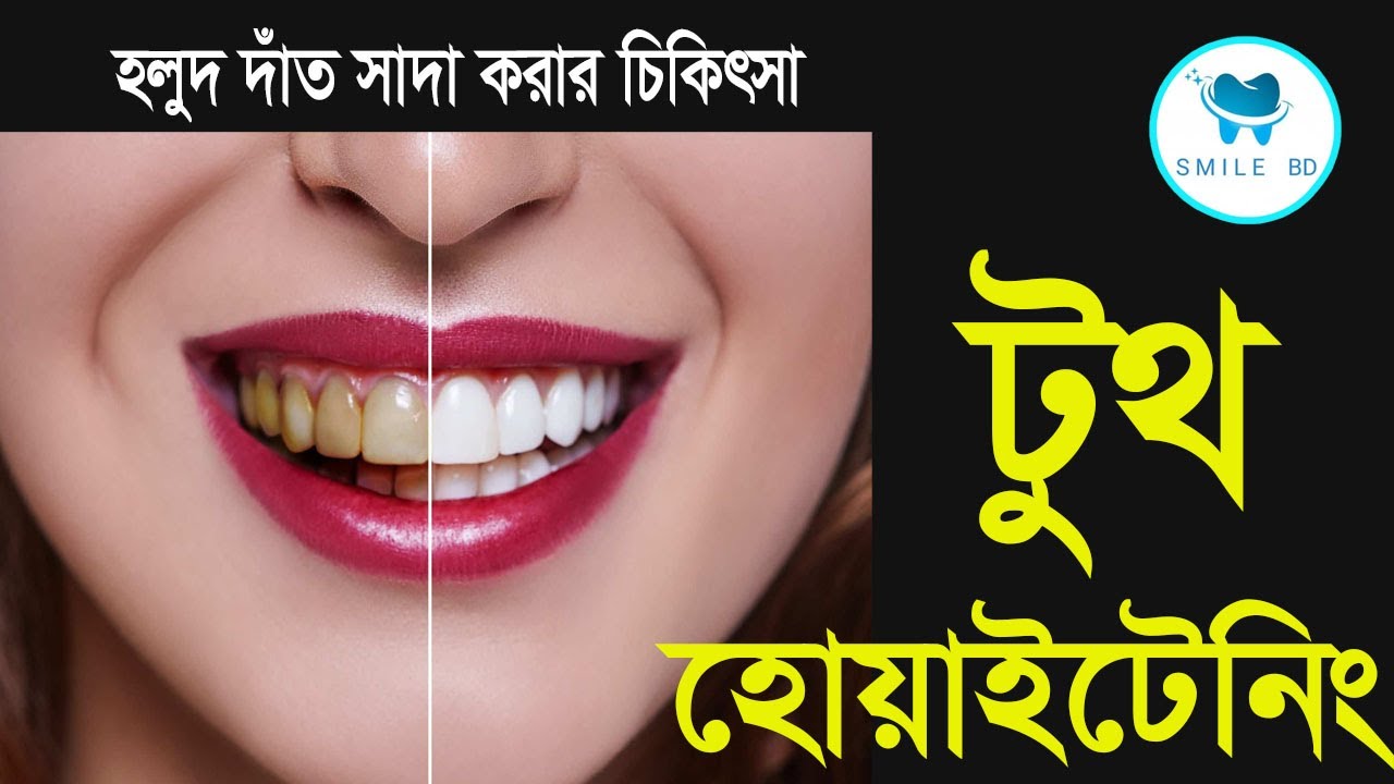 হলদে দাঁত সাদা করার চিকিৎসা .টুথ হোয়াইটেনিং .tooth whitening in bangla ...