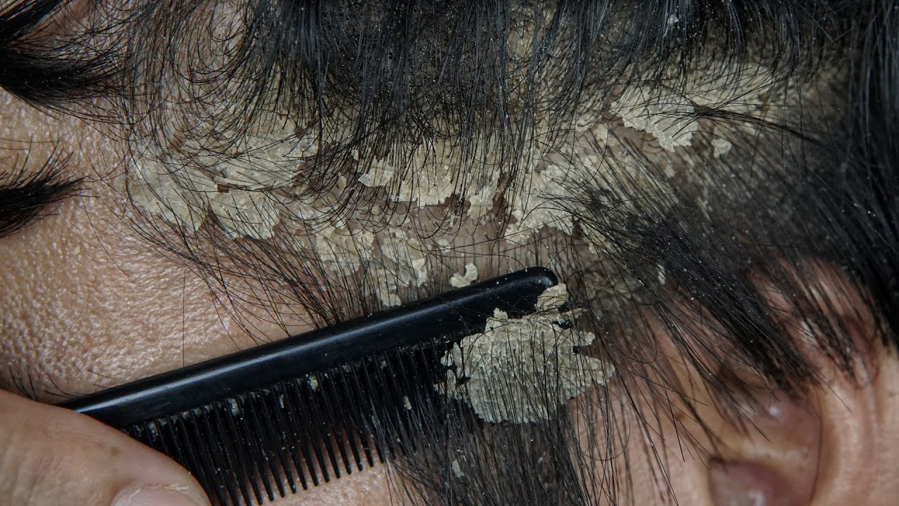 ASMR Satisfying Scalp Scratching with Comb #DKMO2946 - YouTube