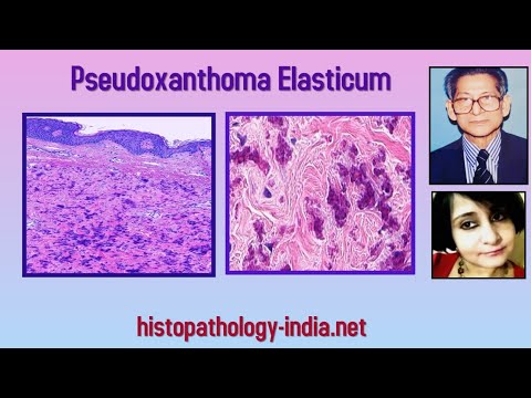 Pathology of Pseudoxanthoma Elasticum - Dr Sampurna Roy MD (dermpath ...
