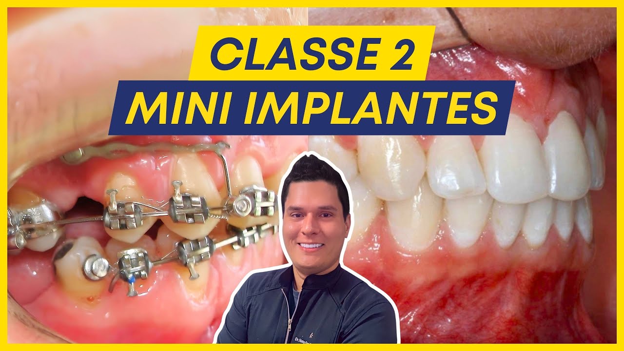 CLASSE 2: COMO TRATAR COM MINI-IMPLANTES? - YouTube
