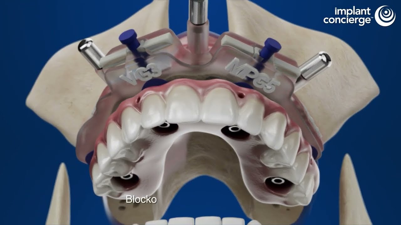 Implant Concierge: Bone Reduction Guide Technical Step-by-Step - YouTube