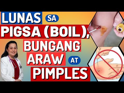 Lunas sa Pigsa (Boil), Bungang Araw at Pimples. By Doc Liza Ramoso-Ong ...