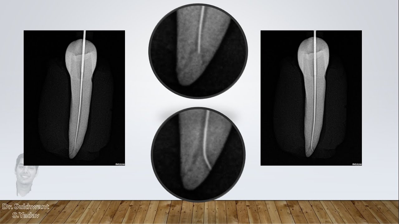 Apical Scouting during RCT - YouTube