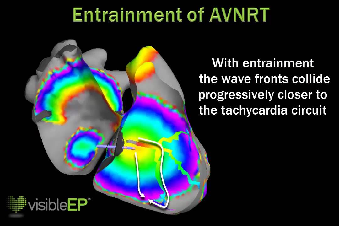 Entrainment of AVNRT - YouTube