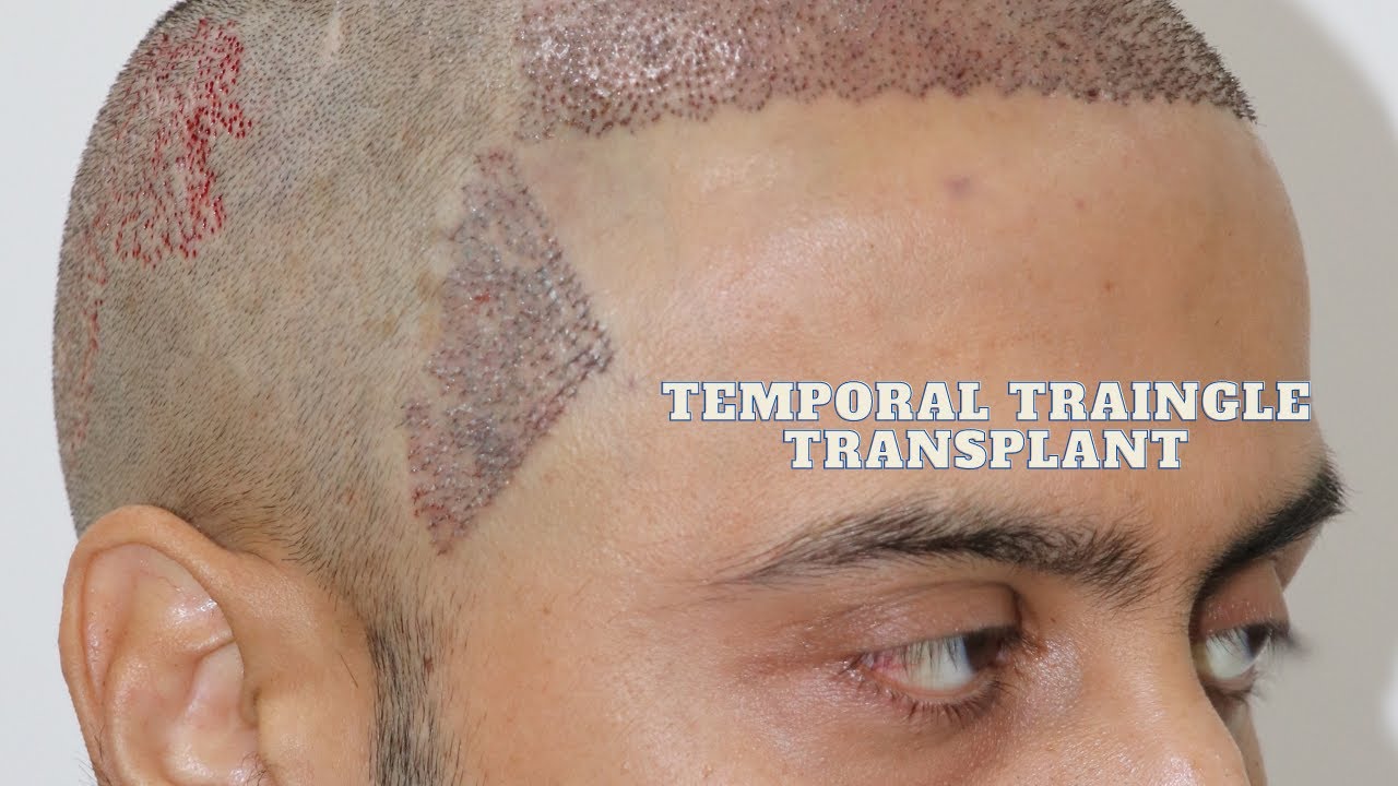 Temporal Triangle Transplant In 2021 || Temporal Triangle Transplant By ...