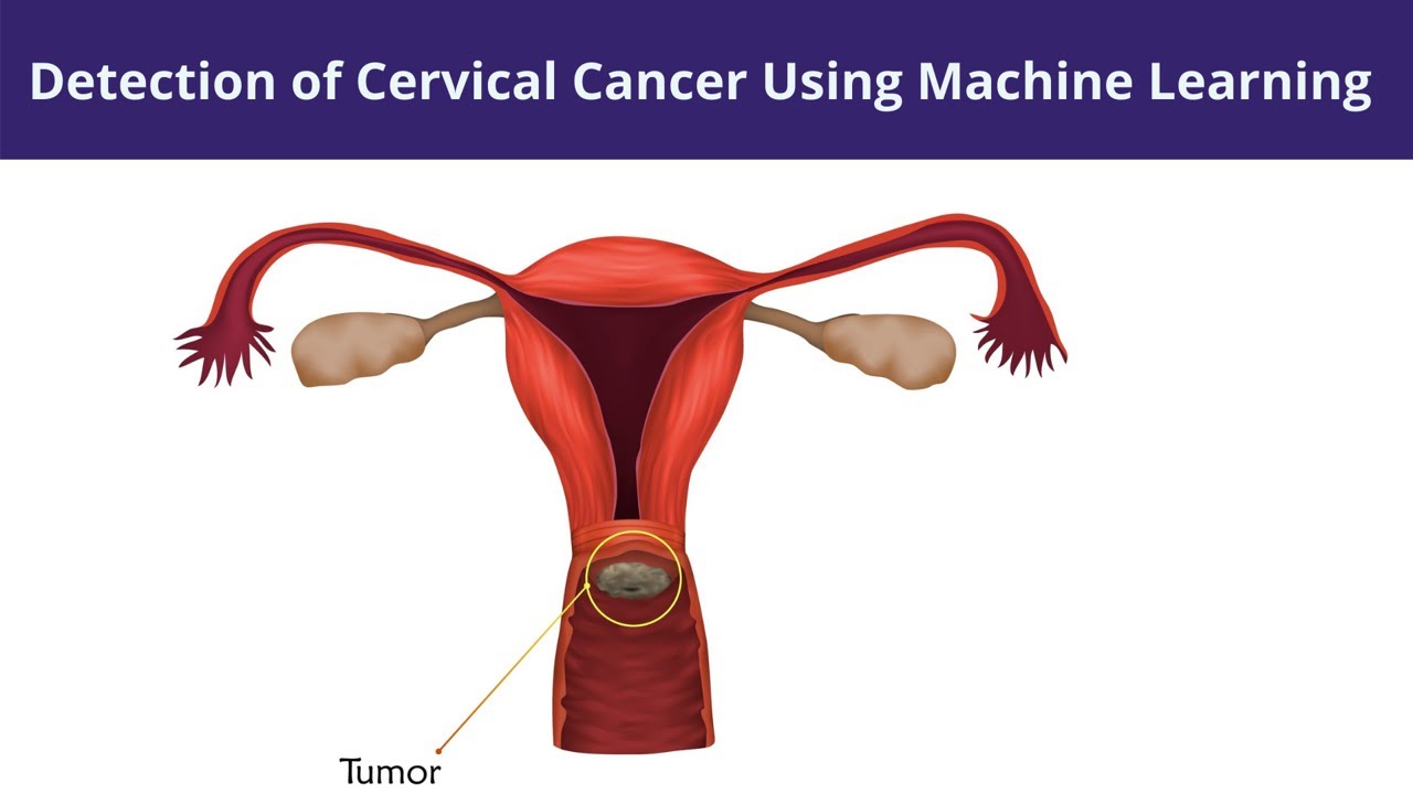 Prediction of Cervical Cancer using Machine Learning in Python | Machine Learning Project in ...