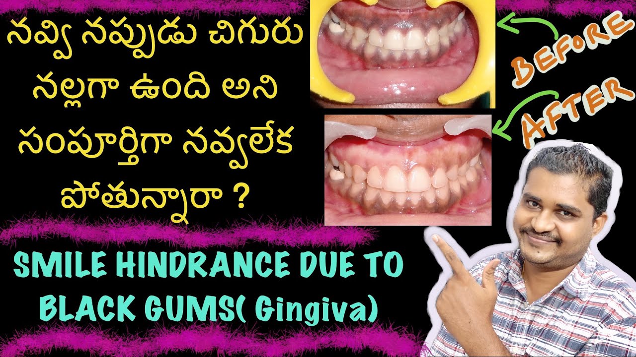 Causes of Black Gums (Gingiva) || Hyperpigmentation || చిగురు నల్లగా ...