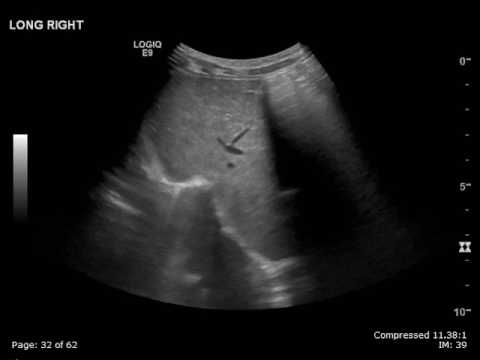 Paradoxical Diaphragm Motion on Ultrasound - YouTube