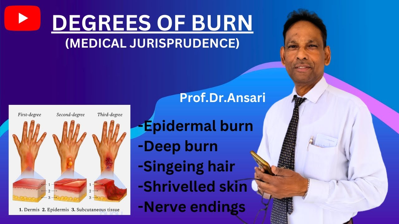 Degrees of burn | Epidermal burn | Deep burn | Singeing hair ...