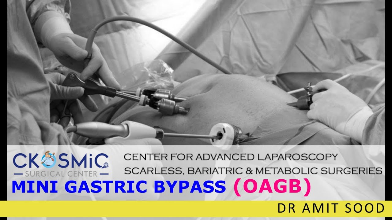 MINI GASTRIC BYPASS ( OAGB ) . DR AMIT SOOD - YouTube