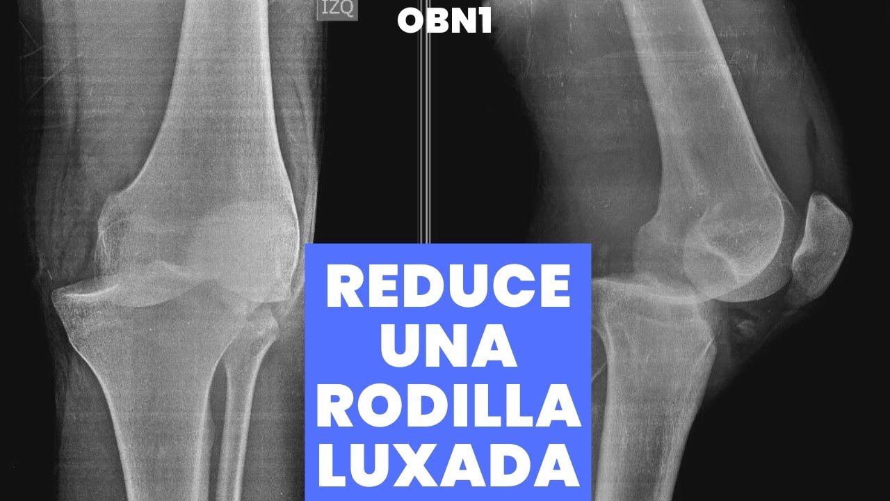 RODILLA LUXADA O DISLOCADA - APRENDE A REDUCIRLA - YouTube
