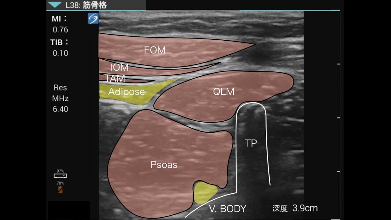 QLB Murouchi approach - YouTube
