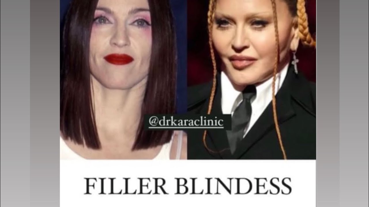 Madonna | Then & Now | Celebrity Aesthetics Dermal Filler Blindness ...