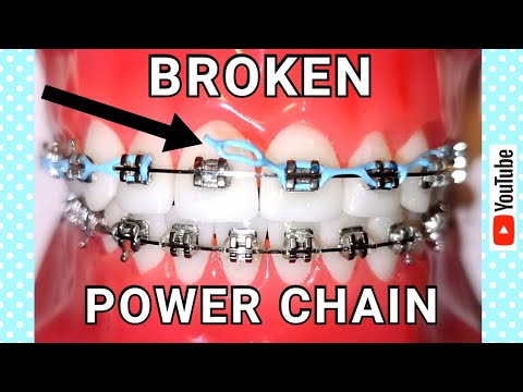 What To Do If Your Braces Power Chain Breaks