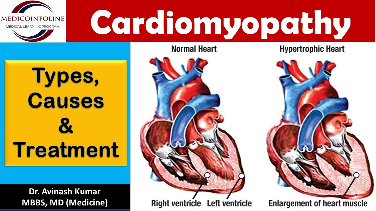 Cardiomyopathy | Cardiomyopathy treatment - YouTube