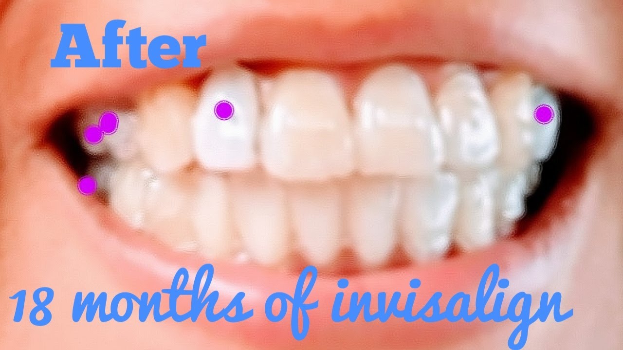 Last Pair of Invisalign/ Waiting my Retainer - YouTube
