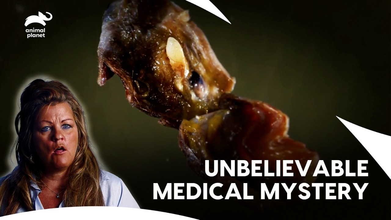Dermoid Teratoma Cyst: Young Girl Crawl Backward To The Bathroom ...