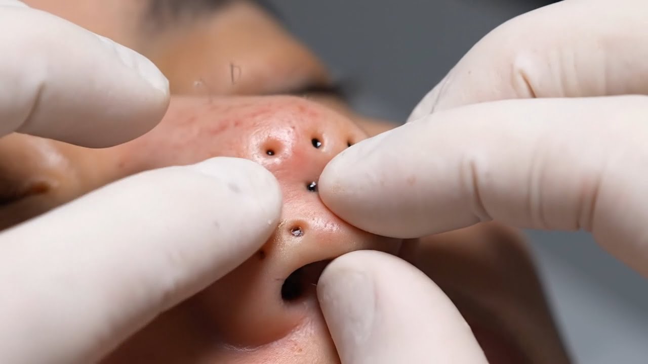Nose Blackhead Removal — Extreme Macro Extractions - YouTube