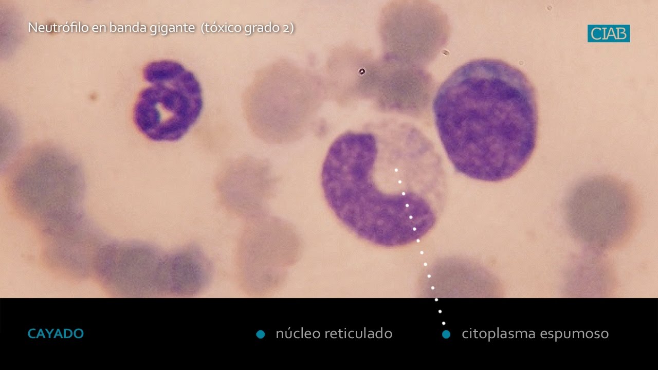 Vacuolización De Neutrófilos