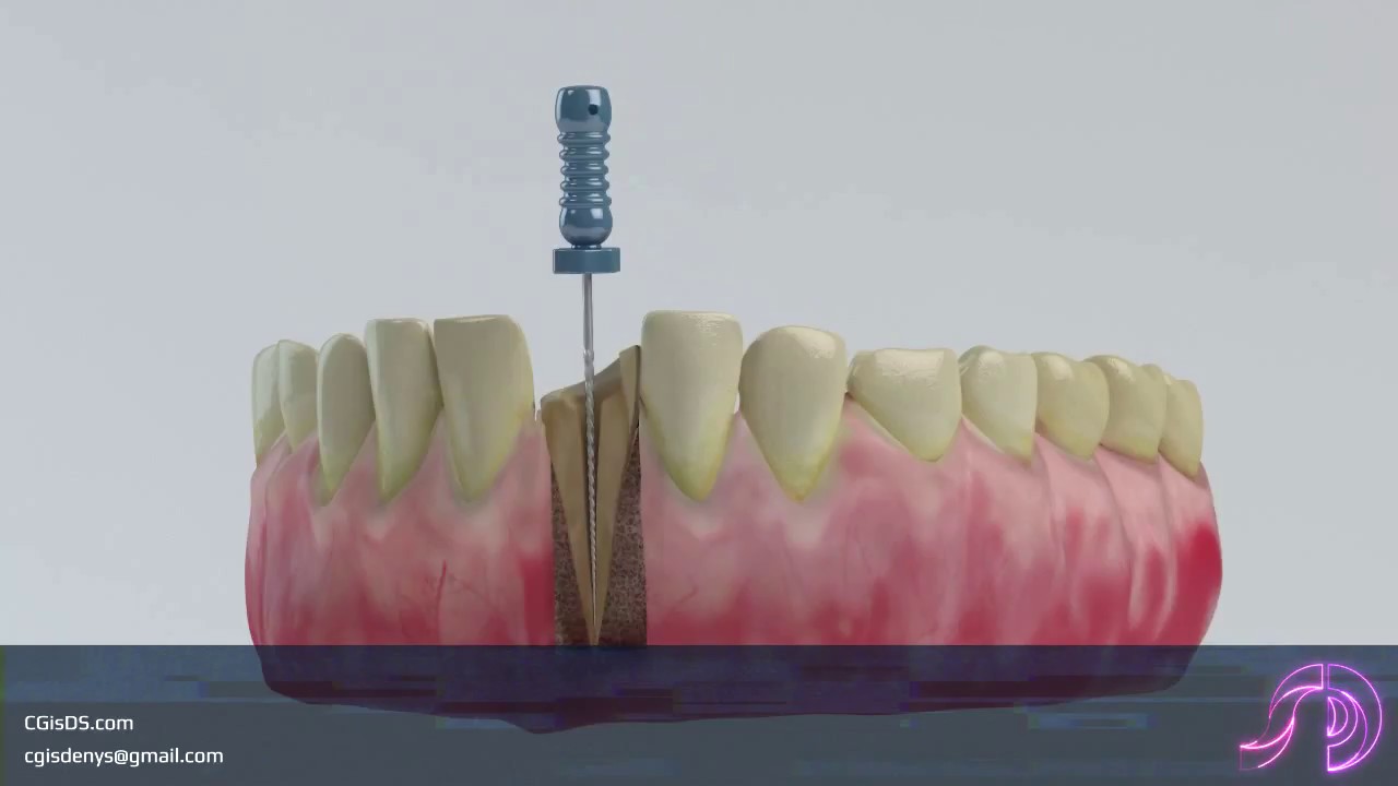 Medical animation: Treatment of tooth caries-affected - YouTube