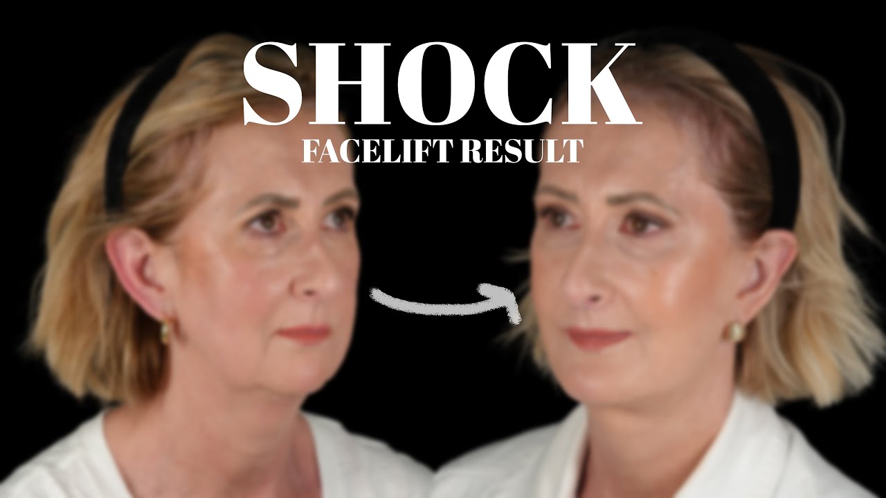 My Facelift Journey with Dr Greg Bran | Real Patient Story & Results ...