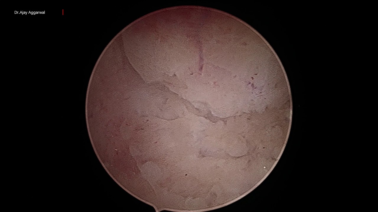 Hysteroscopic polypectomy (removal of polyp) simplified by Dr Ajay ...