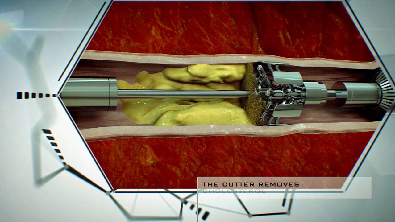 Dahir Insaat: Cholesterol Deposit Removal - YouTube
