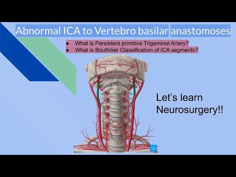 Persistent Primitive trigeminal Artery (PPTA), ICA-VB anastomoses ...