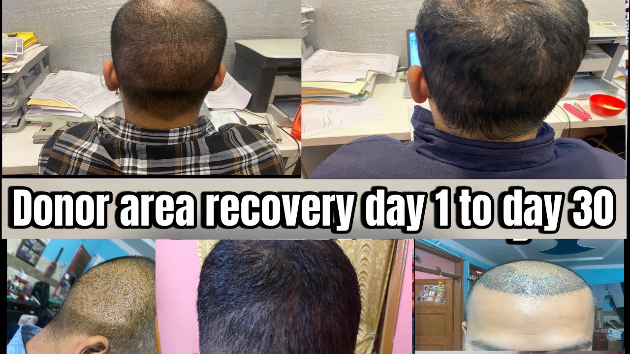 Hair Transplant Donor Area Time Lapse | Donor Area recovery after hair transplant | Day 1 to 15 ...