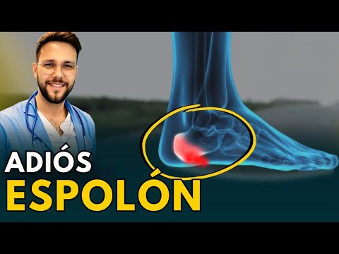 Espolones calcáneos: tratamiento en el hogar que realmente funciona