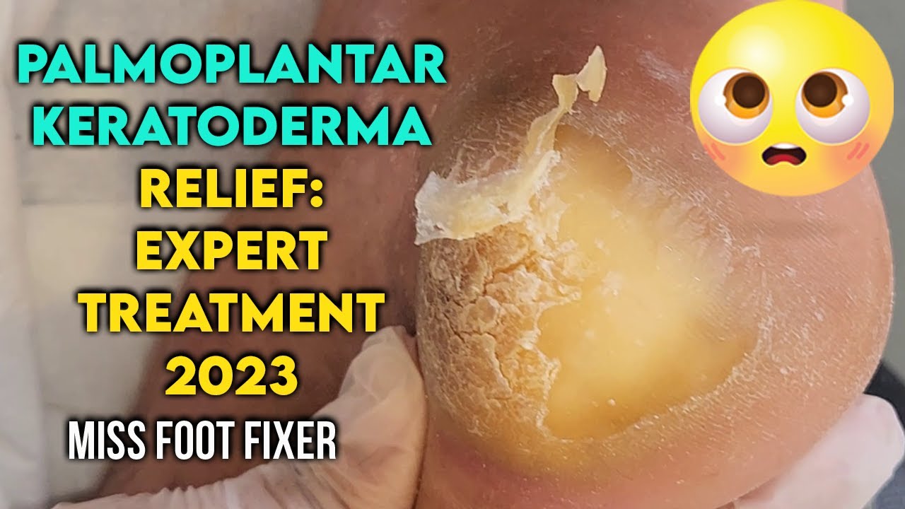 Palmoplantar Keratoderma Relief: Expert Treatment for Thick Callus ...