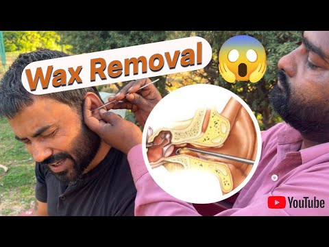 Indian Street Ear Cleaning | Satisfying Ear Wax Removal ASMR