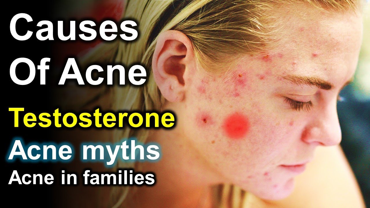 Causes Of Acne | Testosterone, Acne in families, Acne in women, Acne ...