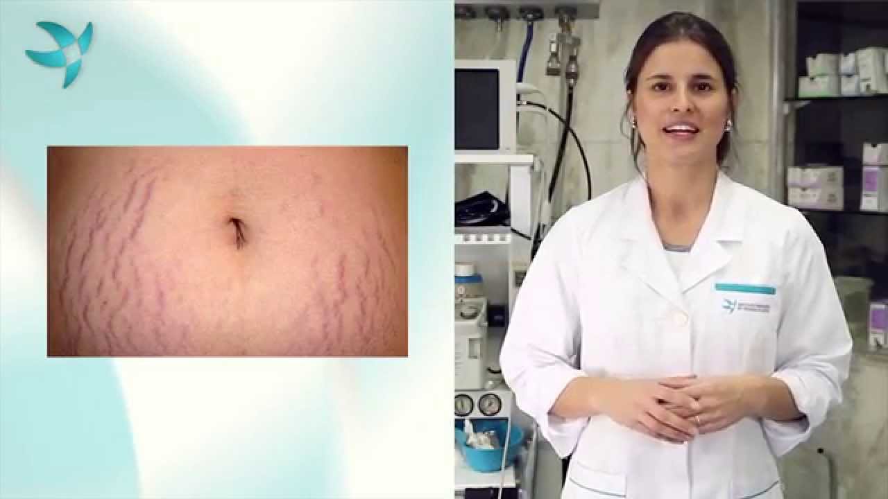 Tratamentos para as Estrias - YouTube