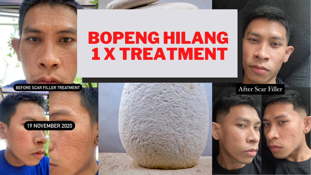 CARA MENGHILANGKAN BOPENG - SCAR TREATMENT DALAM WAKTU YANG SINGKAT ...