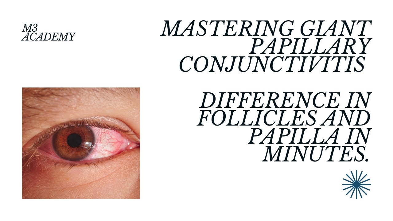 Giant Papillary conjunctivitis Follicles, Papilla Simplified Mnemonics ...