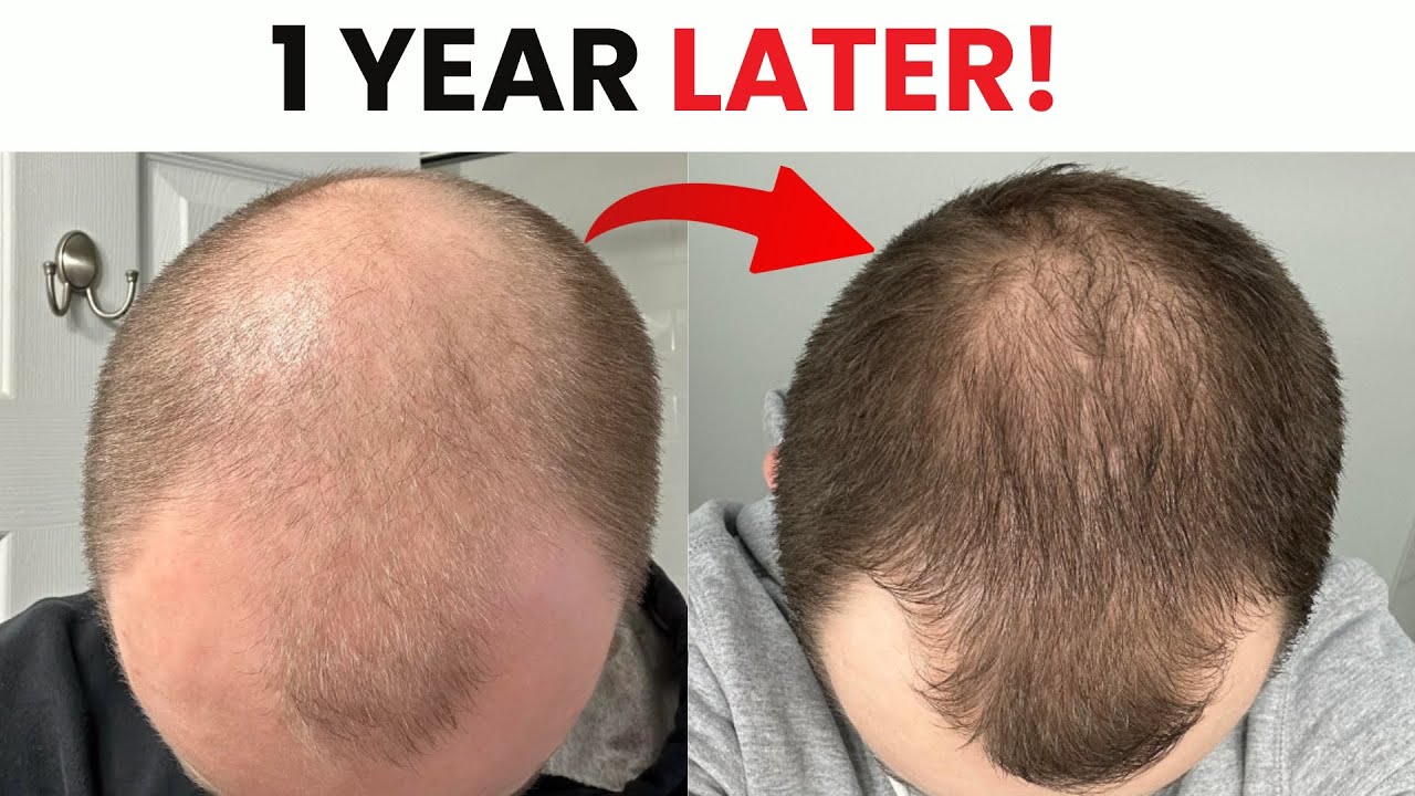The 1-Year Finasteride Rule Before a Hair Transplant (Many Guys Ignore ...