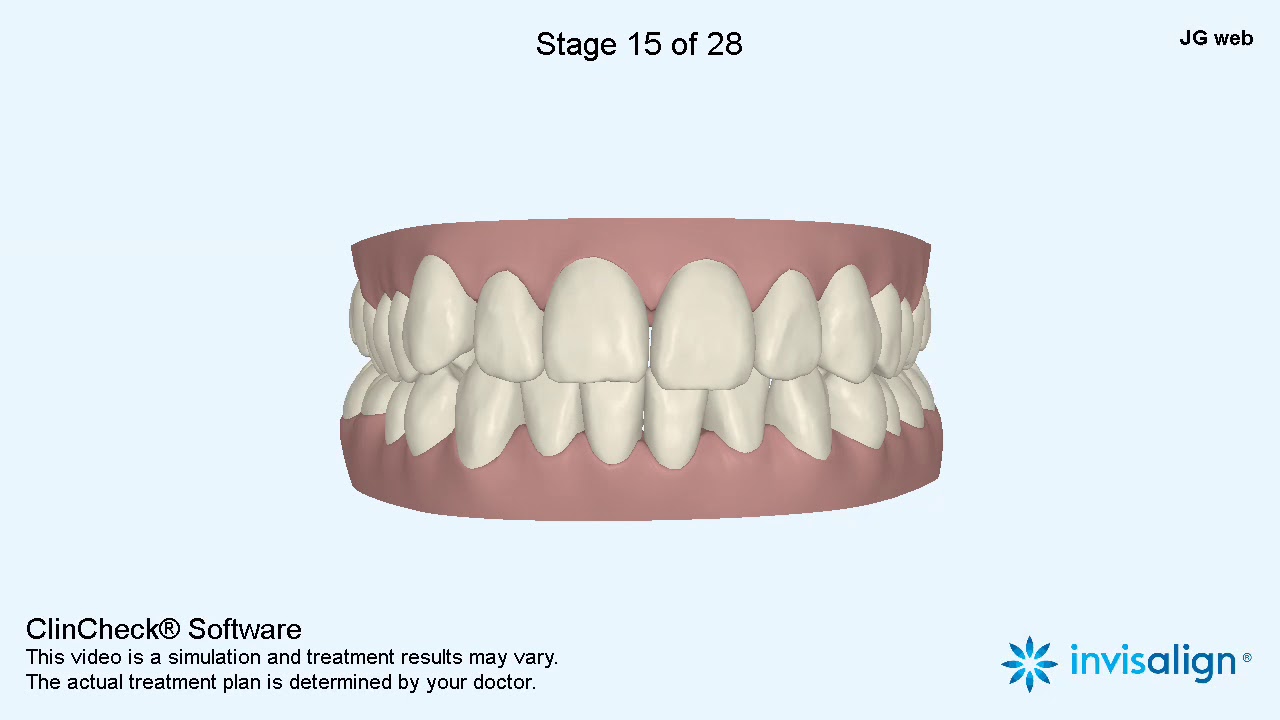 Invisalign Simulation - YouTube