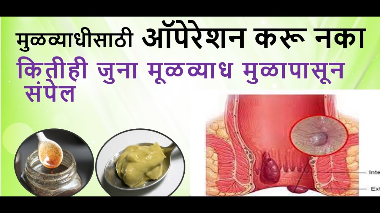 मुळव्याध वर घरगुती उपाय | mulvyadh var gharguti upay piles treatment ...