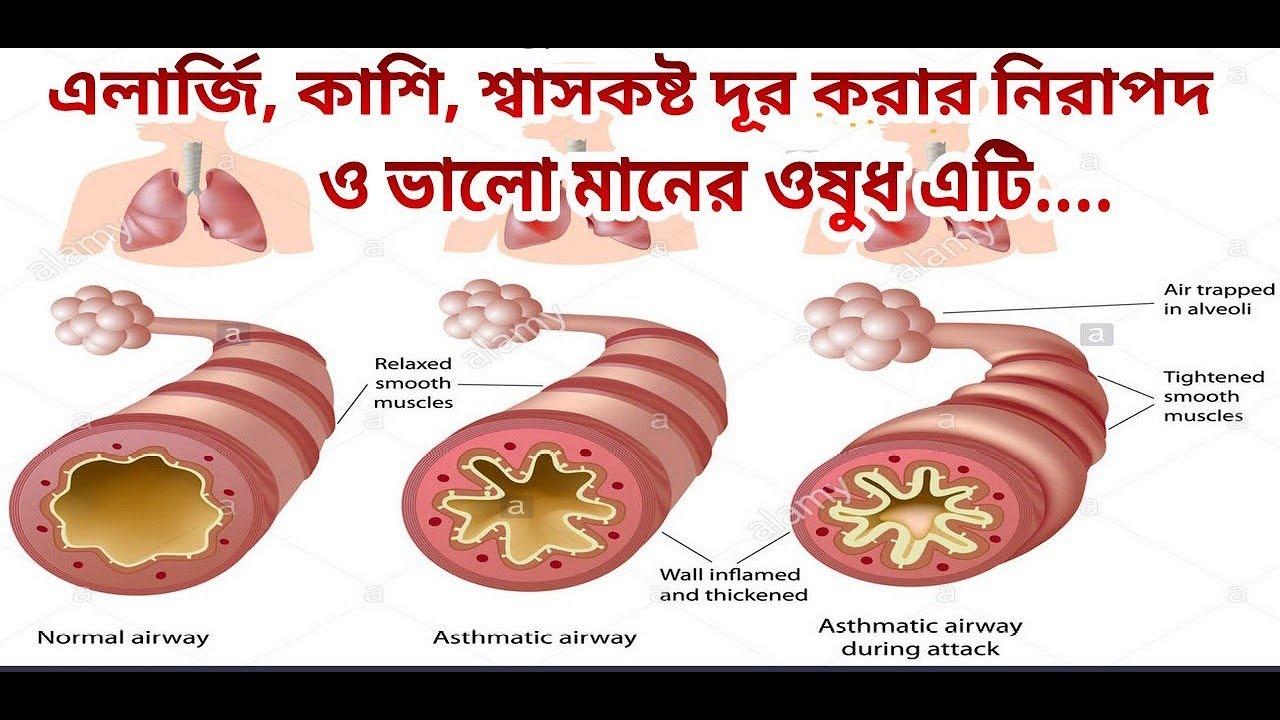M-kast tablet 10,5,4mg এলার্জি, কাশি, শ্বাসকষ্ট দূর করার নিরাপদ ও ভালো ...