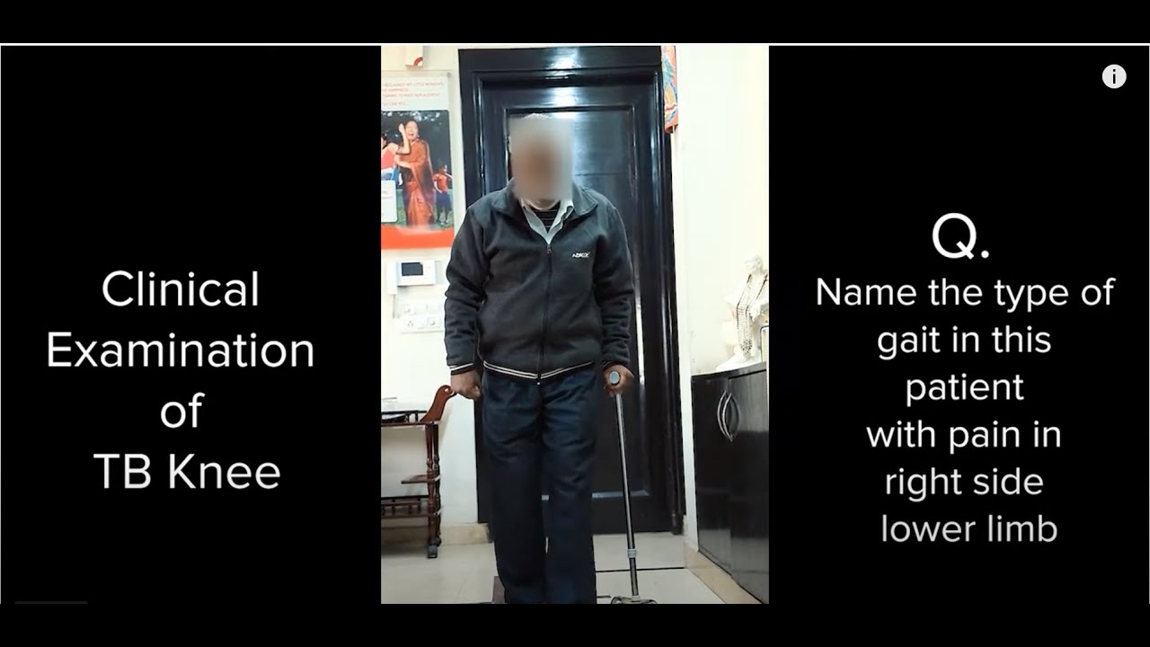 Clinical Examination of a Case of TB Knee - Conceptual Orthopedics ...