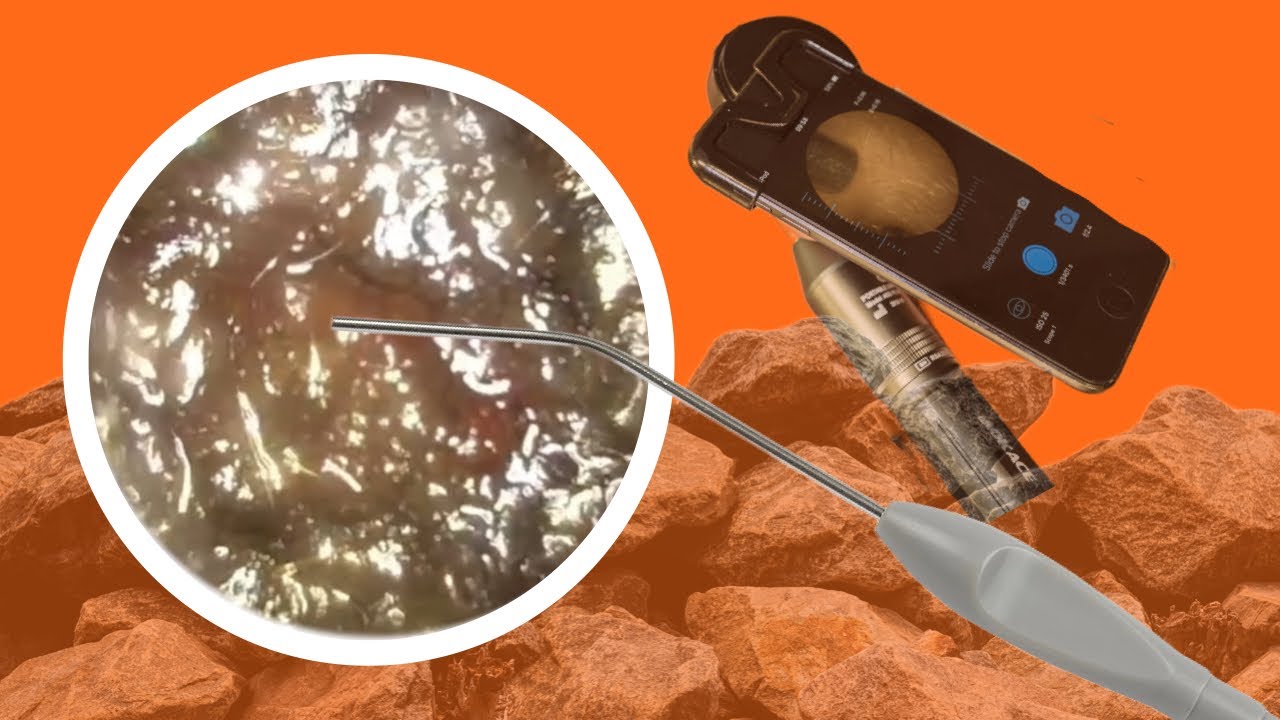 We tackle a ROCK HARD ear wax plug. #001 - YouTube